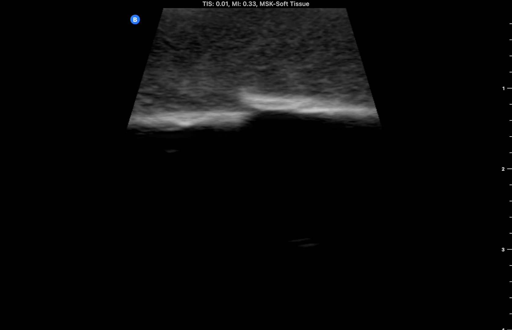 Ultrasound Phantom - Bone Fracture, Light | Adam,Rouilly