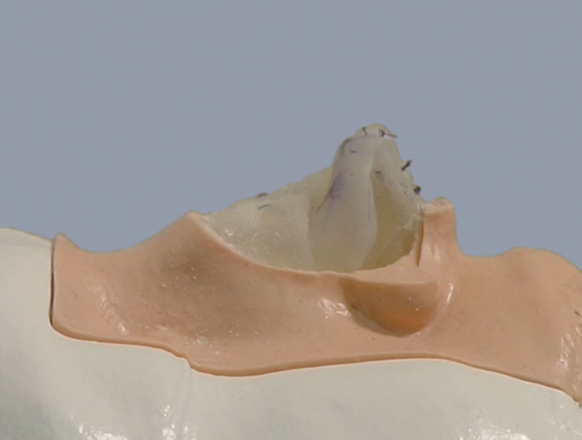 Rhinoplasty Model | Adam Rouilly