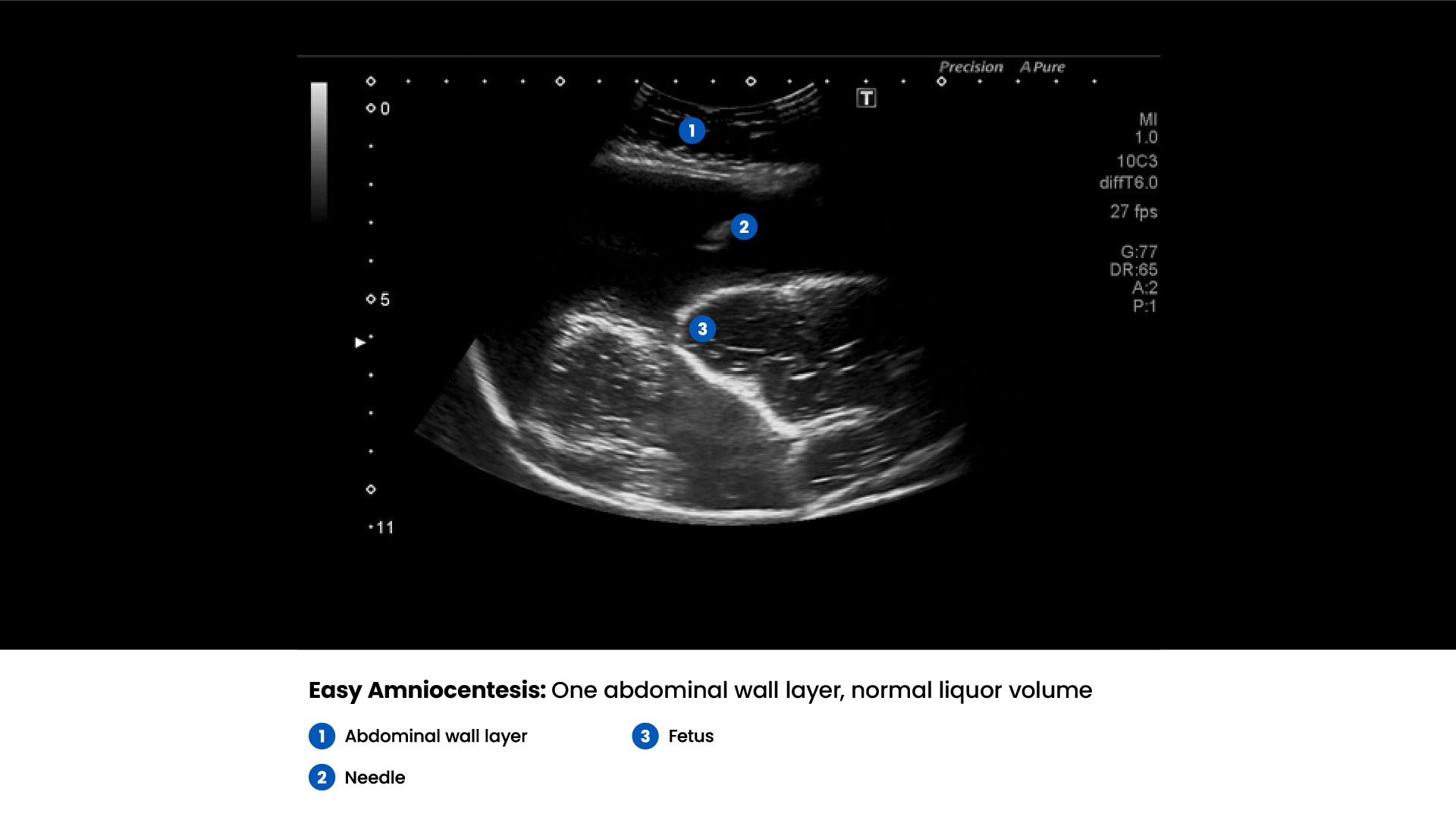 Amnio Abby® - Ultrasound Guided Invasive Procedures Simulator | Adam ...