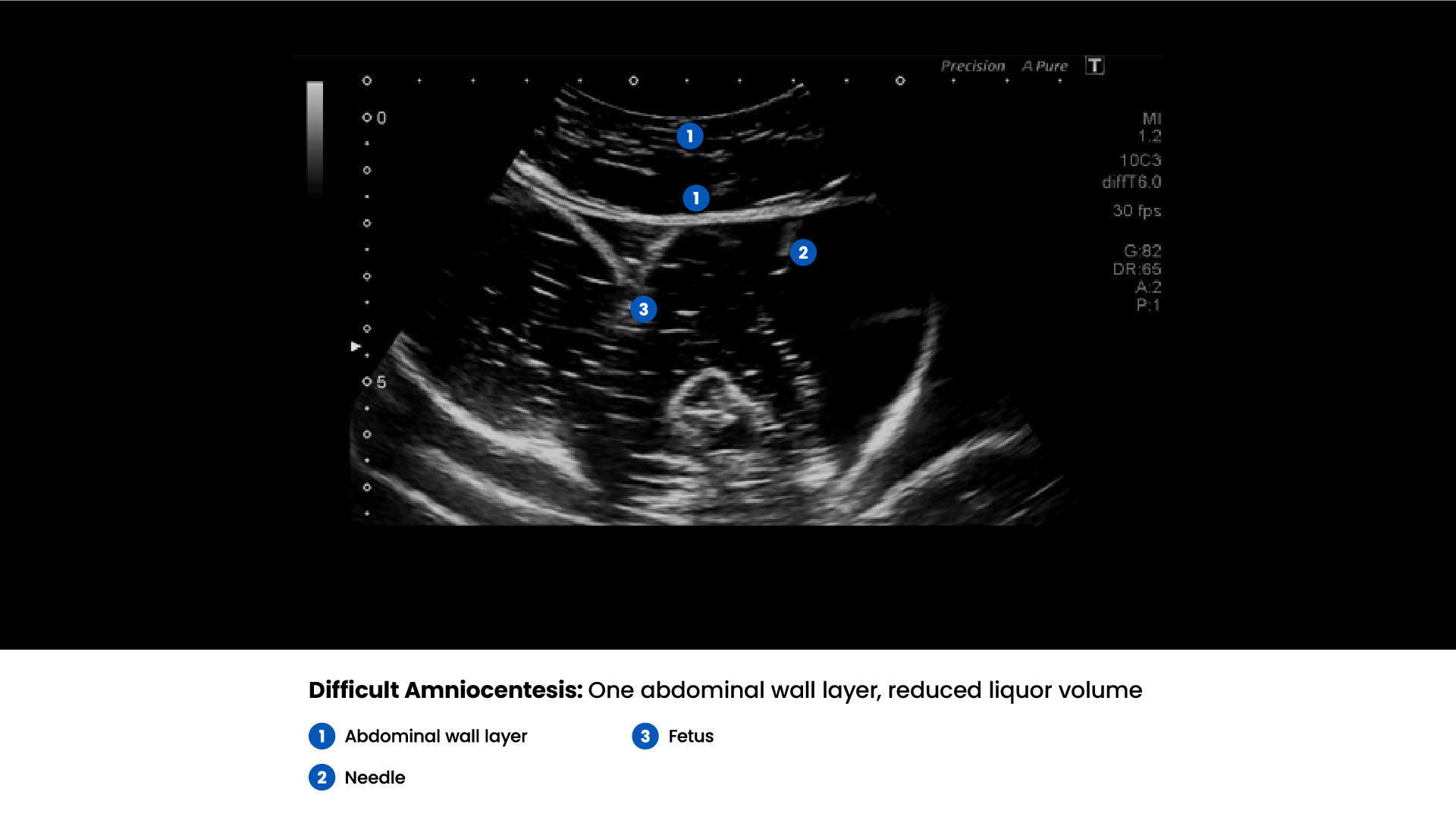 Amnio Abby® - Ultrasound Guided Invasive Procedures Simulator | Adam ...