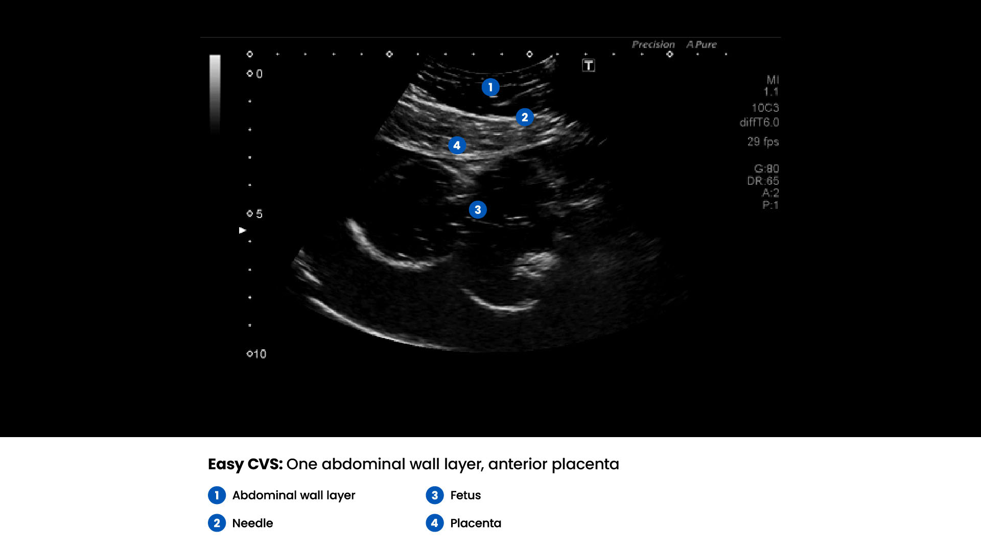 Amnio Abby® - Ultrasound Guided Invasive Procedures Simulator | Adam ...