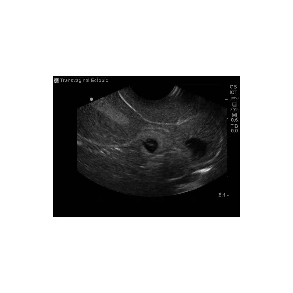 Transvaginal Ultrasound Early Pregnancy Revisiting Ectopic Pregnancy: