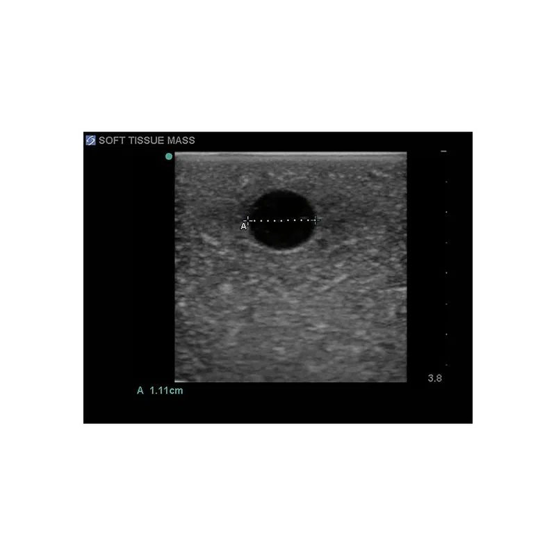 Breast Elastography Ultrasound Training Model | Adam,Rouilly