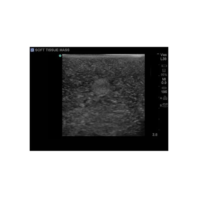 Breast Elastography Ultrasound Training Model | Adam,Rouilly