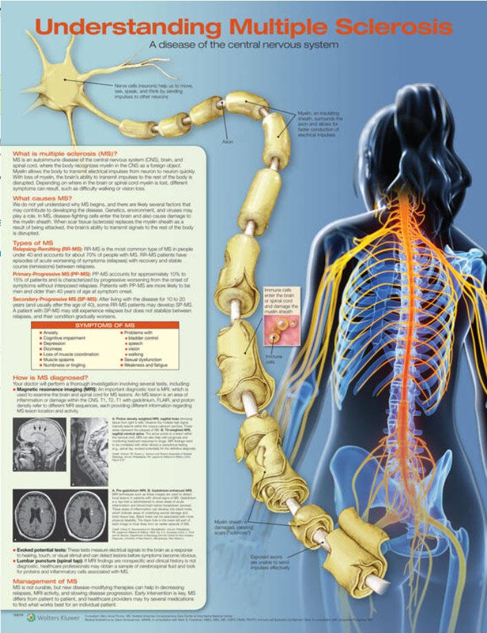Understanding Multiple Sclerosis Chart - Adam,Rouilly