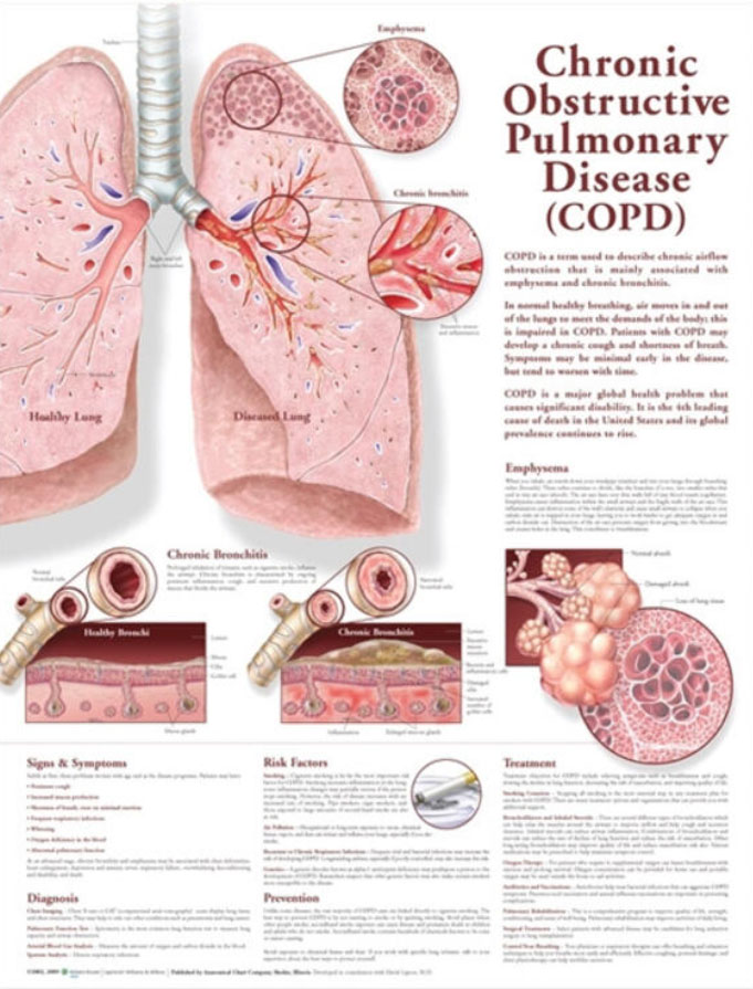 Chronic Obstructive Pulmonary Disease Chart - Adam,Rouilly