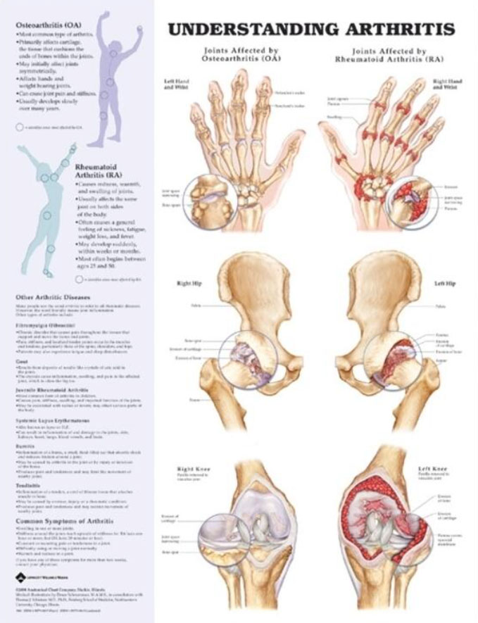 Understanding Arthritis Chart - Adam,Rouilly