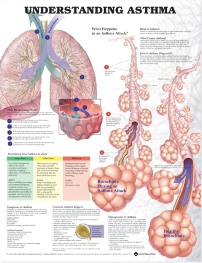 Understanding Asthma Chart - Adam,Rouilly