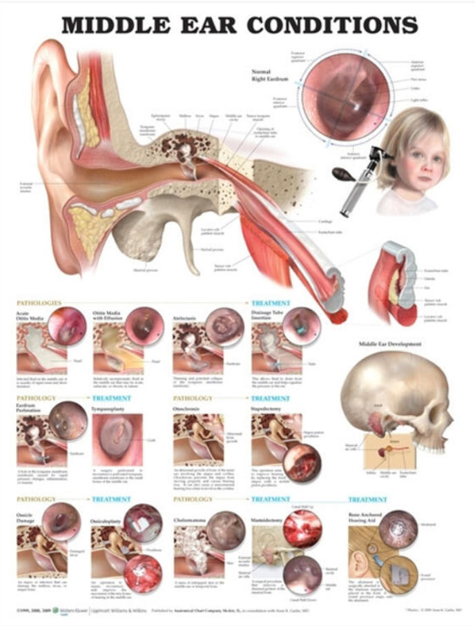 Middle Ear Conditions Chart - Adam,Rouilly
