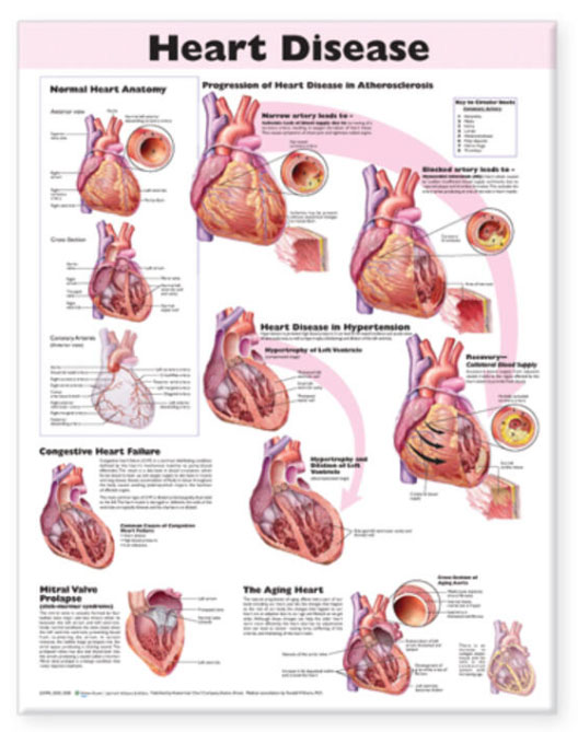 Heart Disease Chart - Adam,Rouilly
