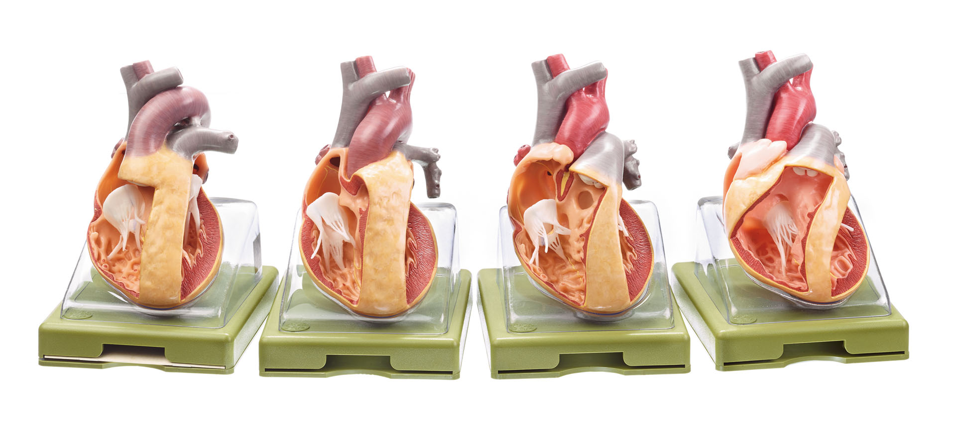 Series of Models Representing Congenital Organic Heart Diseases - Adam ...