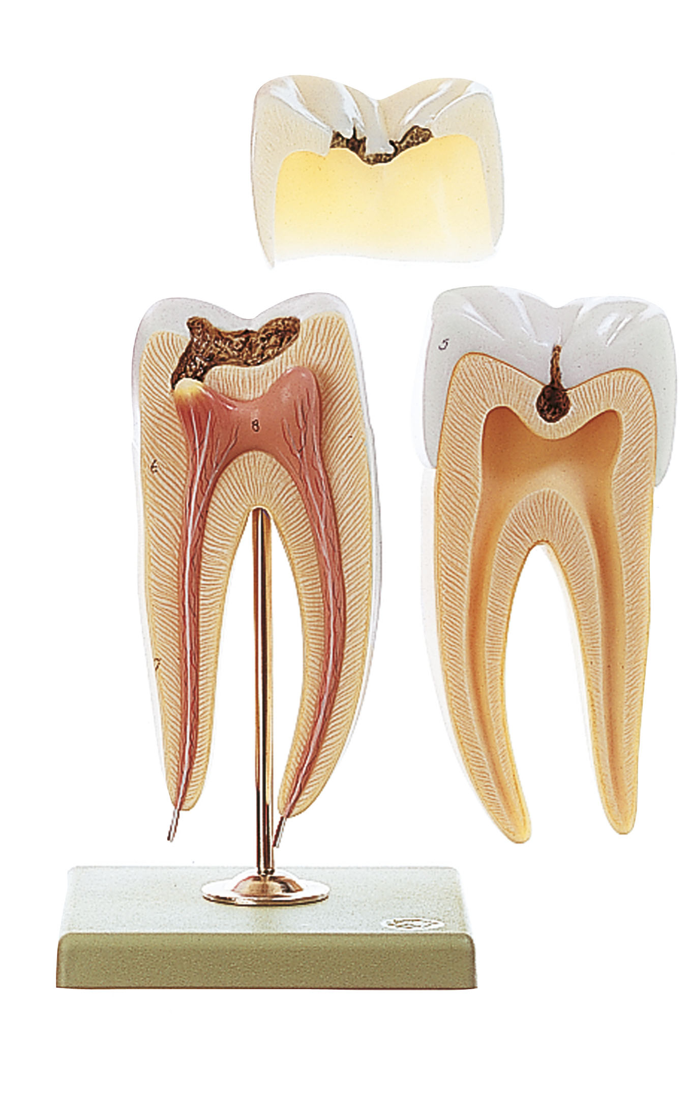 Molar Tooth With Caries - Adam,Rouilly