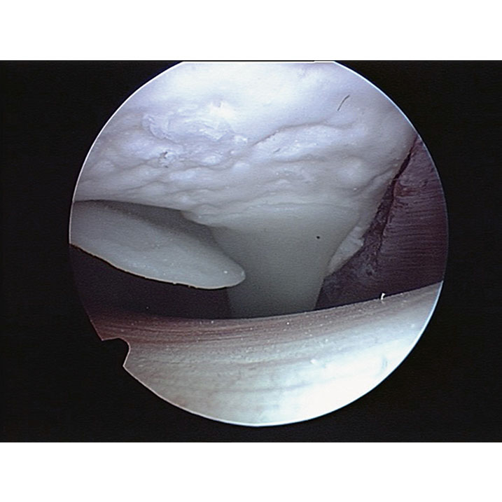Arthroscopy Model of the Shoulder - Adam,Rouilly