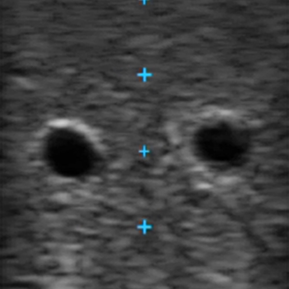 Vascular Access Ultrasound Phantom, Dark | Adam,Rouilly